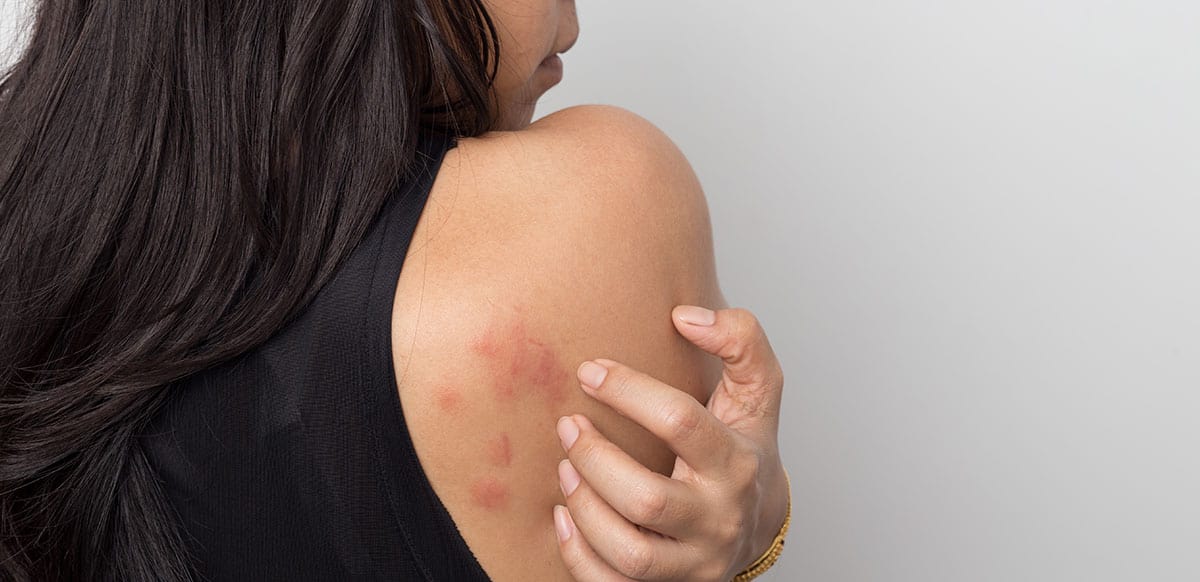 Pictures Skin Rashes Humans Is My Rash Ringworm Or Something Else?